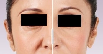 AB Esthetic: Aesthetic Medicine for Dummies - Fillers