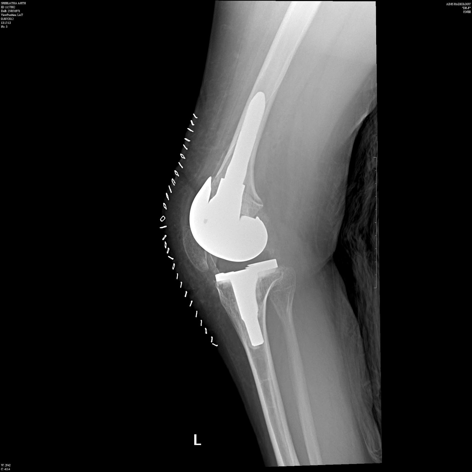 Joint Preservation and Replacement : May 2012