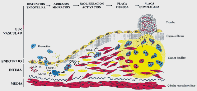 Medicina UNLP - Patología: Ateroesclerosis - Clasificación de las lesiones