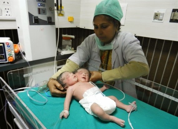'Very, Very Rare' Conjoined Twins : Child Born With Two Head In India ...
