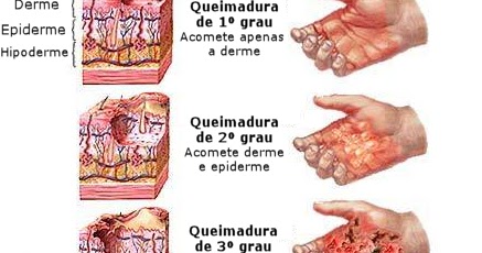 ePORTUGUÊSe: Queimou-se? Saiba como agir e principalmente o que NÃO fazer!