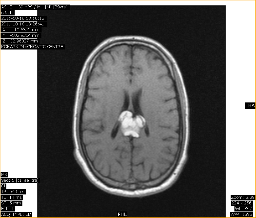 drvcsradiodiagnosis: corpus callosal lipoma- case report