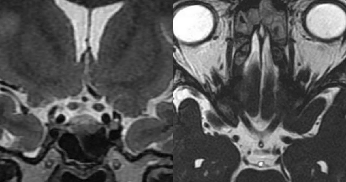 Neuroradiology Cases: Optic Nerve Atrophy MRI