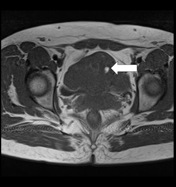Ultimate Radiology : Adenomyosis of Uterus