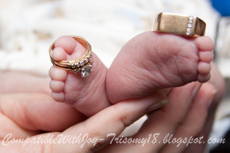 Compatible With Joy-Trisomy18: Correcting Aaron's Rocker Bottom Feet
