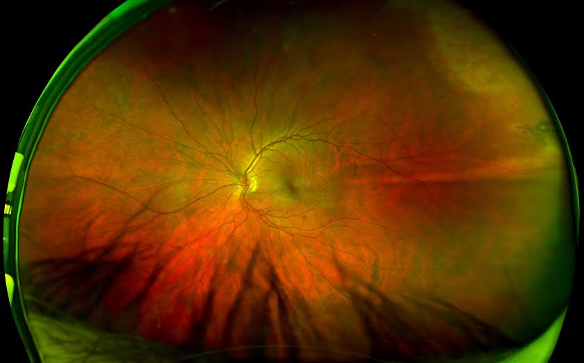How Retinal Imaging Can Save a Life: A Case Study - Eyedolatry