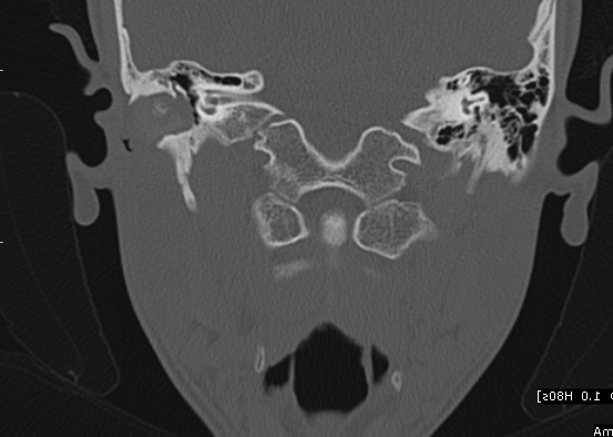 Aural Polyp- CT - Sumer's Radiology Blog