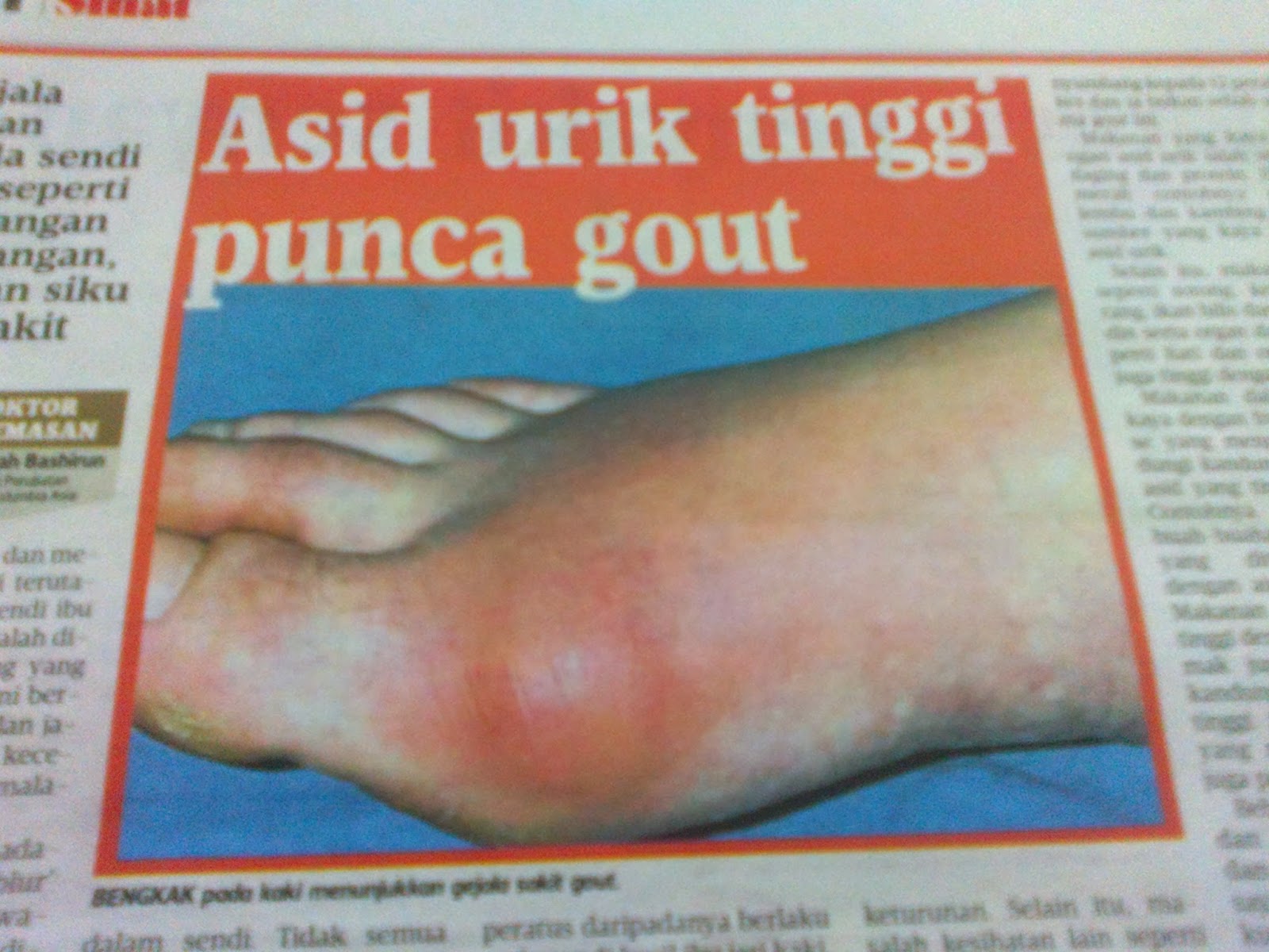 TIPS KEWANGAN TAKAFUL & HIBAH FOR ALL FOR LIFE: PUNCA GOUT MENYERANG ANDA