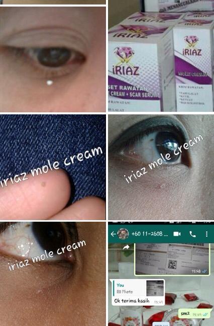 DAFFA IDEAL ENTERPRISE: CARA BETUL APPLY IRIAZ MOLE CREAM