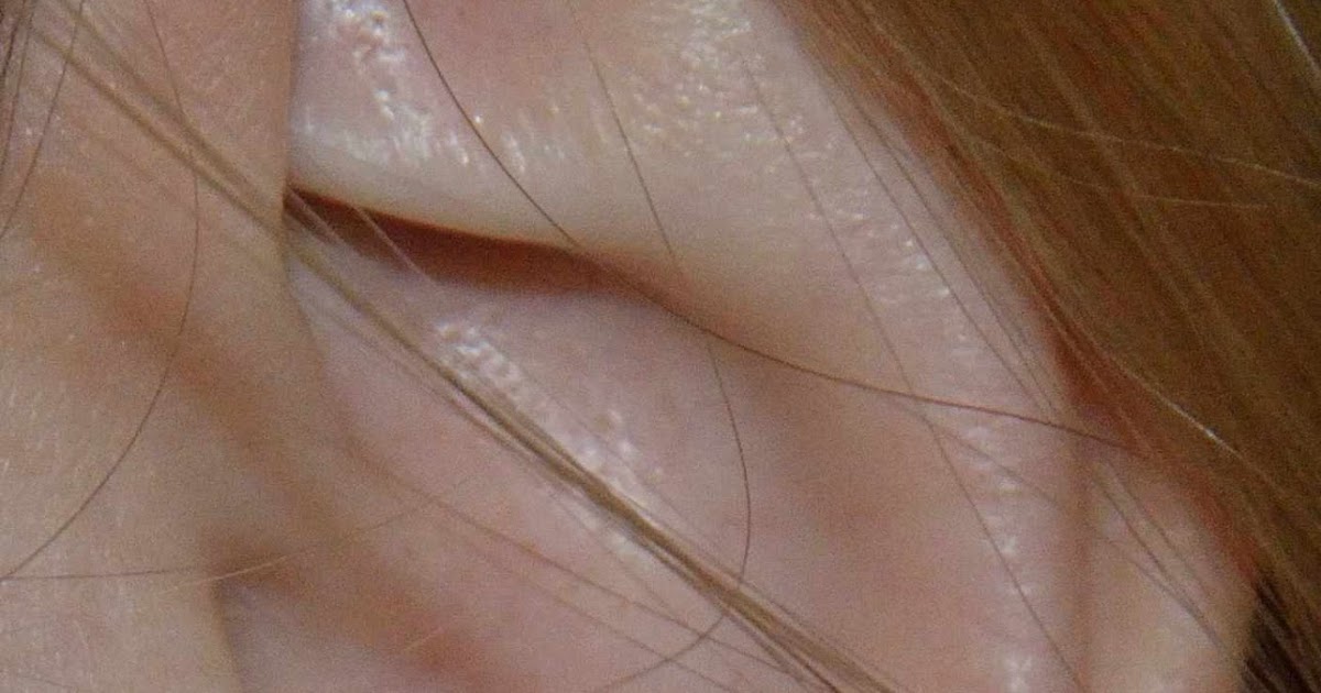 Things that make me go aagghh!: Getting rid of argyria (silver staining ...