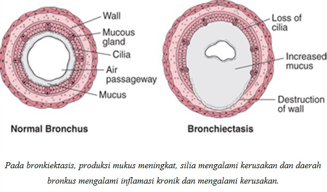 Bronkiektasis - e-Medical