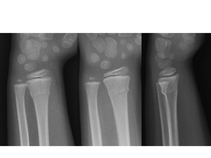 THE A.D.D. E.D.: Torus Fracture (a.k.a. Buckle Fracture)
