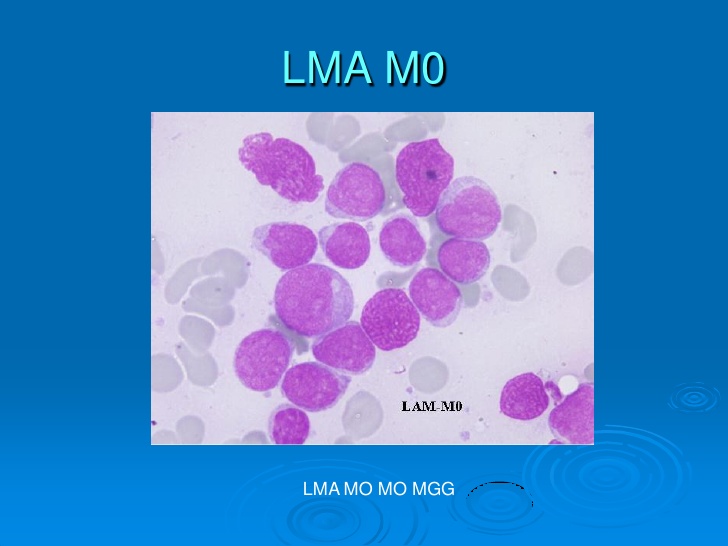 FICHERO DE HEMATOLOGIA 2016: Leucemias.