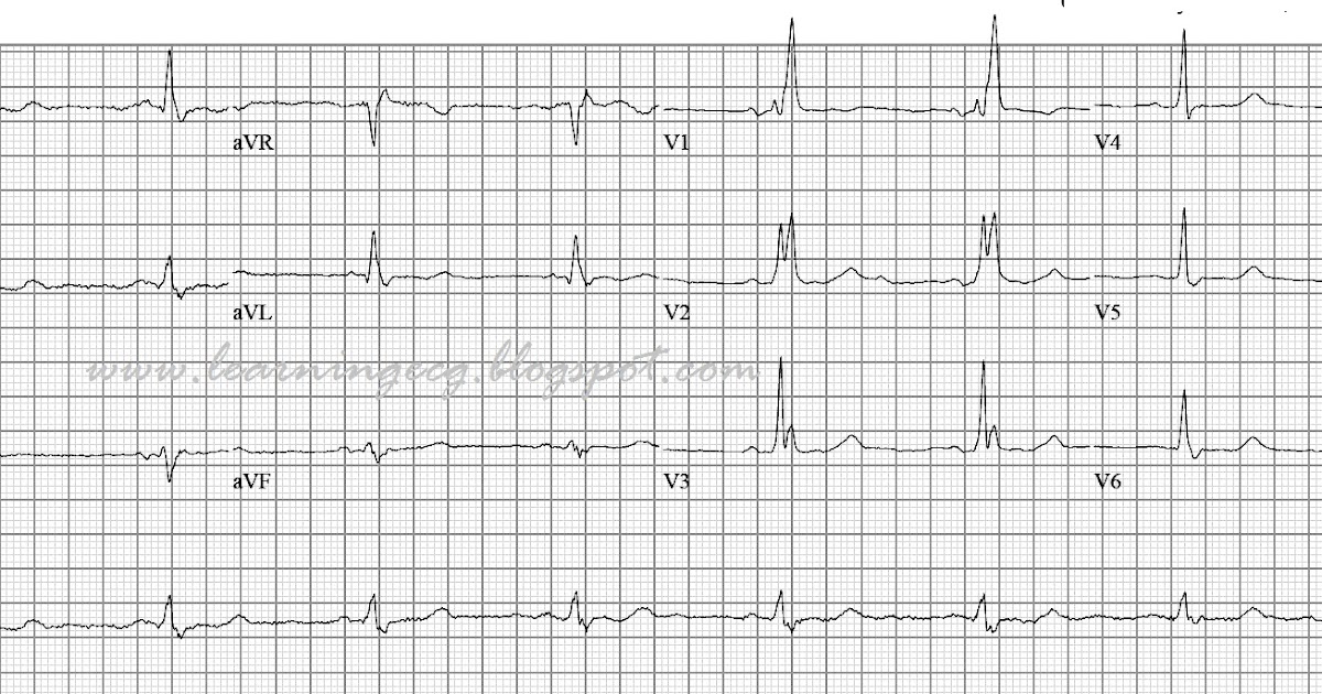 ECG Rhythms: Something wrong with this block