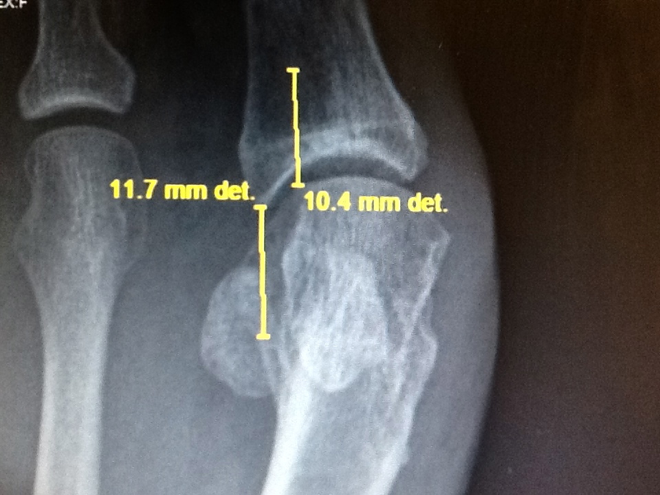 Foot and Ankle Problems By Dr. Richard Blake: Bunion Pain: Medially on ...