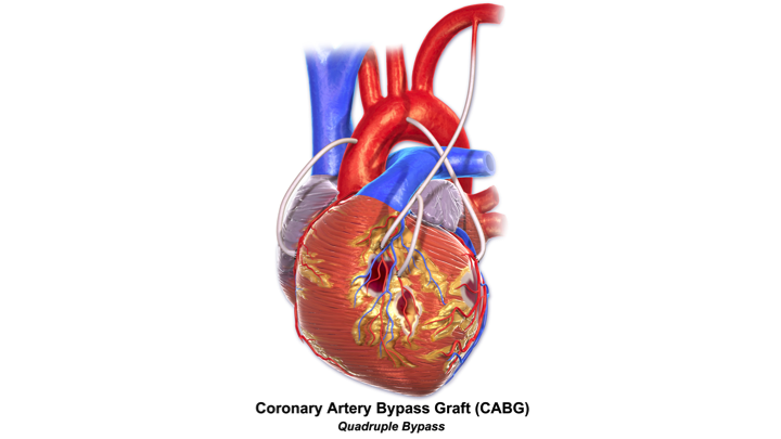 Choice between coronary artery bypass grafting and percutaneous ...