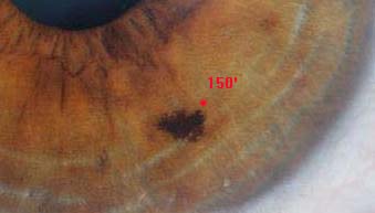 Modern & Multidimensional Iridology: Lipemic Diathesis, Hypertrophy ...