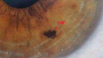 Modern & Multidimensional Iridology: Lipemic Diathesis, Hypertrophy ...