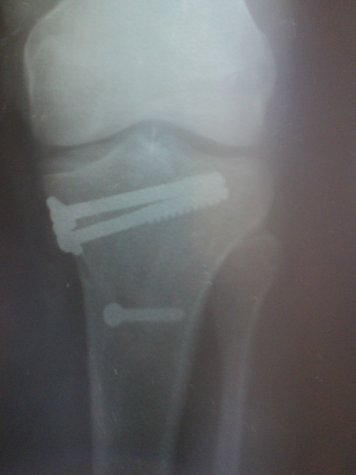 Daniel.OrtoSport: Tratamento cirúrgico de fratura do platô tibial ...