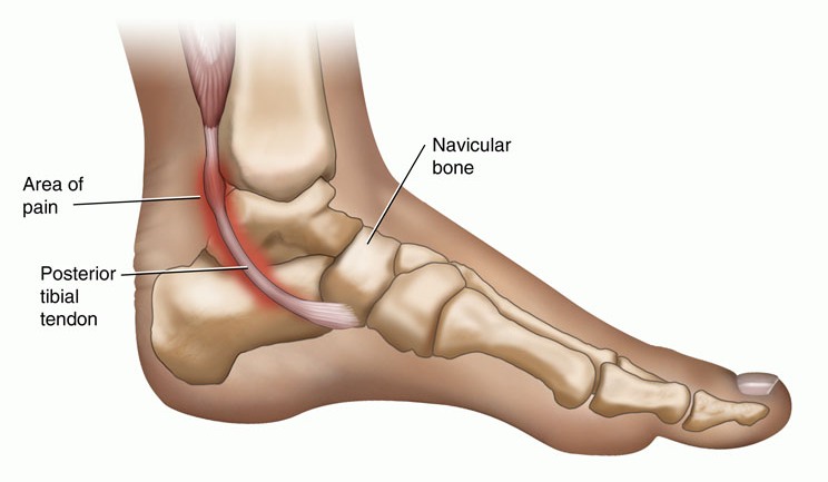Denton Orthopedic Ankle Impingement Syndrome Causes Symptoms And Denton Orthopedic Ankle Impingement Syndrome Causes Symptoms And