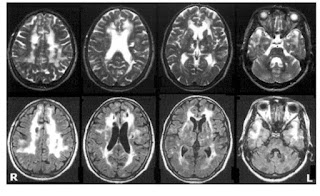 CADASILのガイドライン