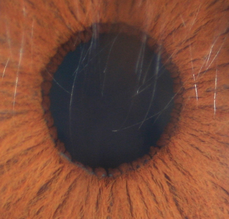 Modern & Multidimensional Iridology: Important iris Signs at IPB, Pupil ...