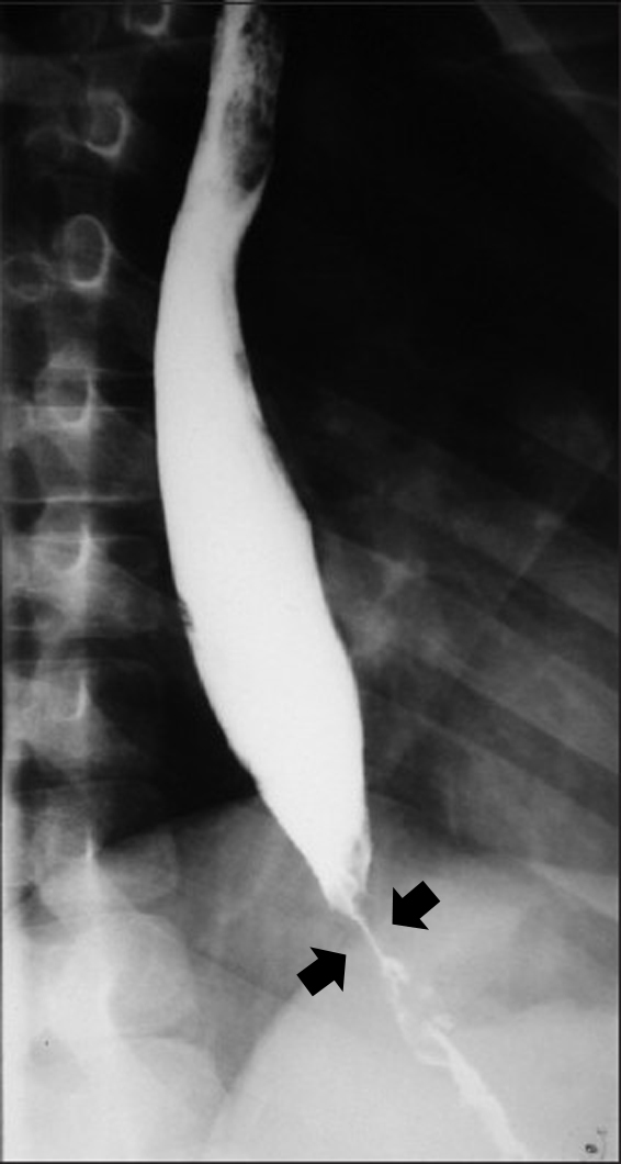 Barium swallow - cancer oesophagus