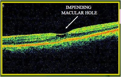 MACULAR OCT | Optometry Education
