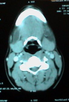 Northland Ear Nose and Throat: Sublingual gland removal for plunging ranula