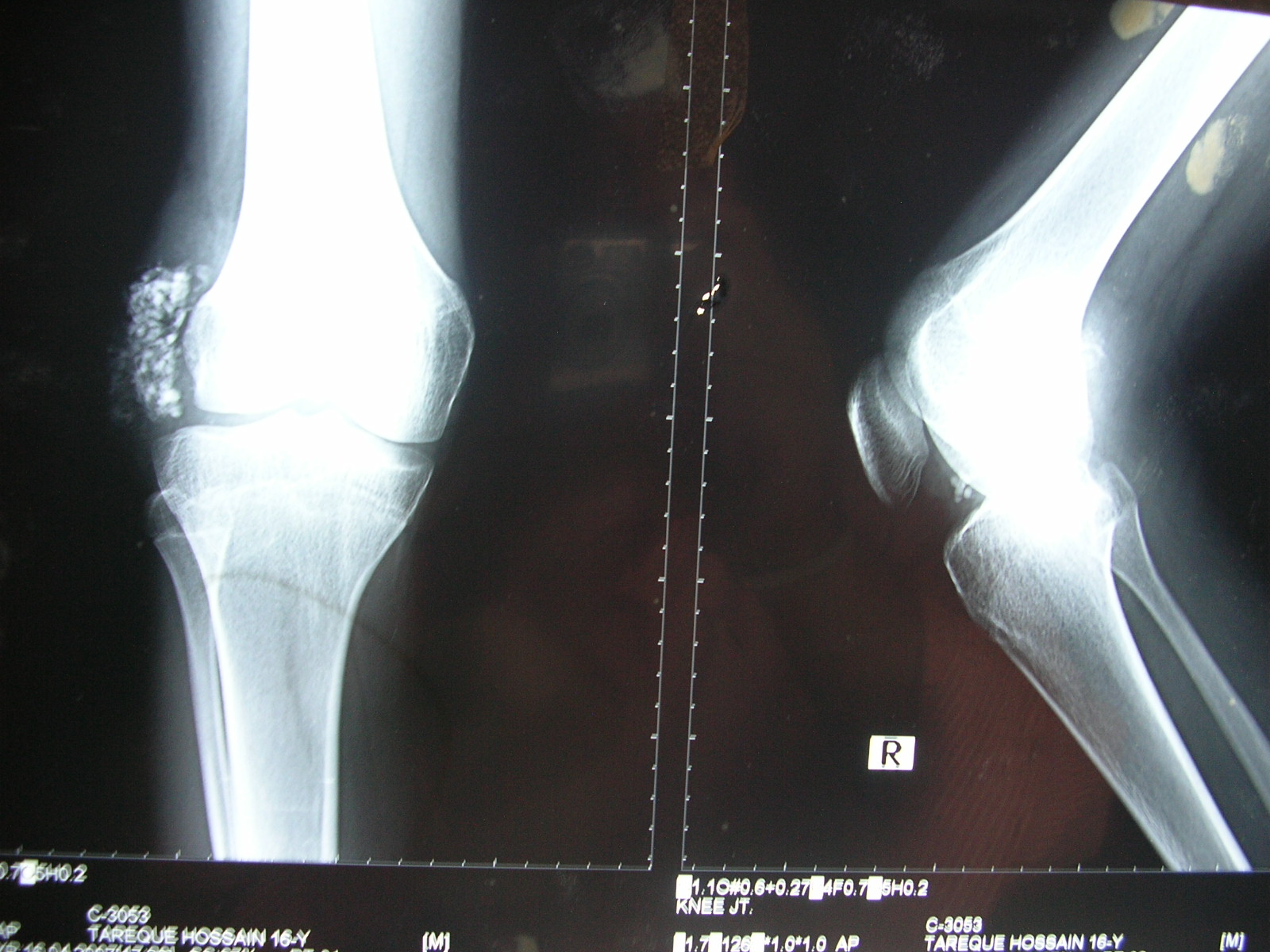X-rays and Slides: Myositis ossificans around knee
