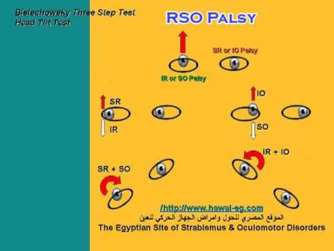 Eye 2 Eye Optometrists: Bielschowsky's head tilt (3 step) test