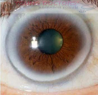 Photos For Arcus Senilis ~ YOUNG DOCTORS' RESEARCH FORUM