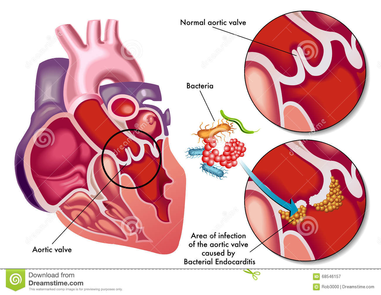 Tratamiento de la Endocarditis Bacteriana