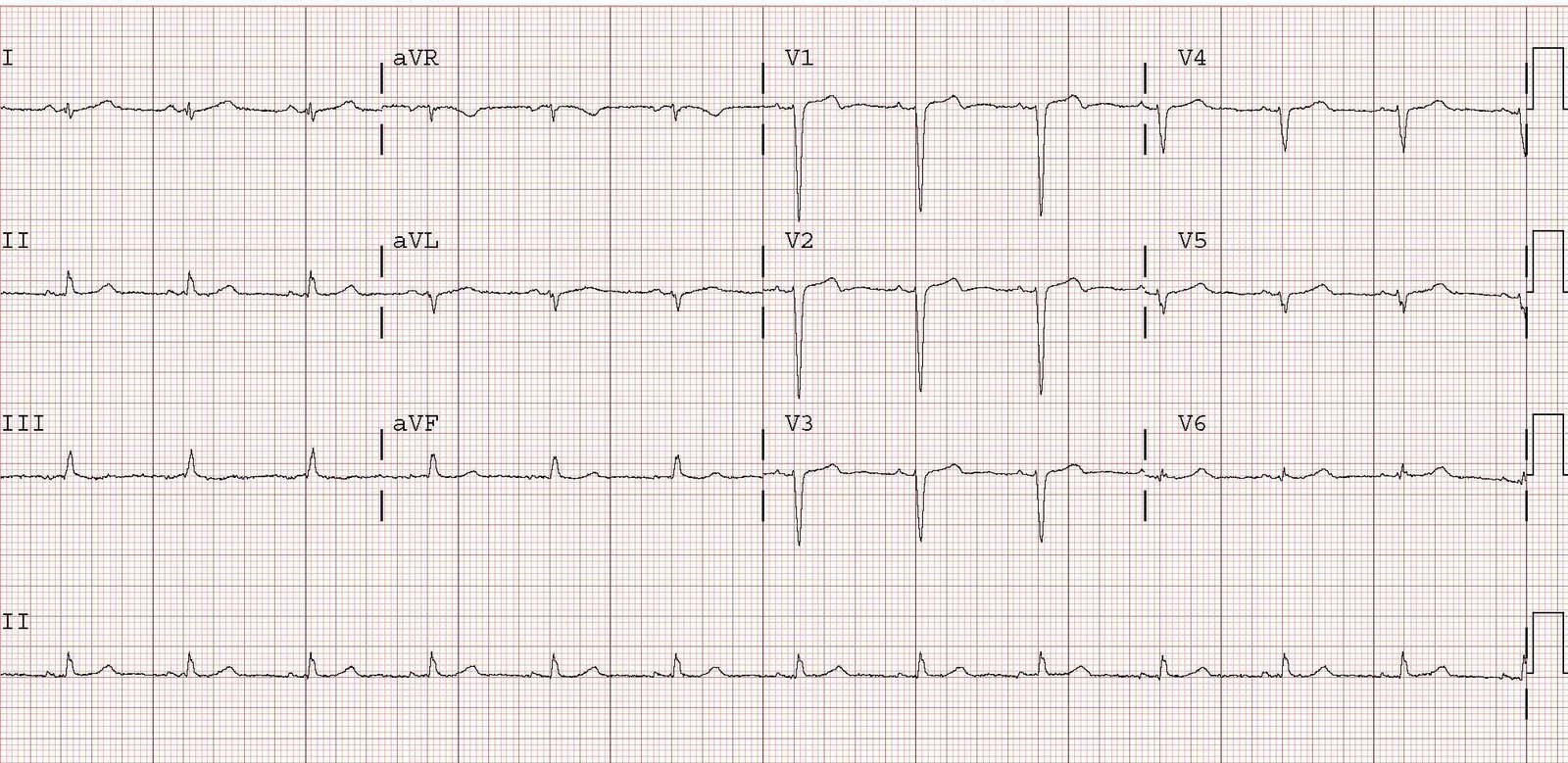 Dr. Smith's ECG Blog: Acute anterior STEMI from LAD occlusion, or ...