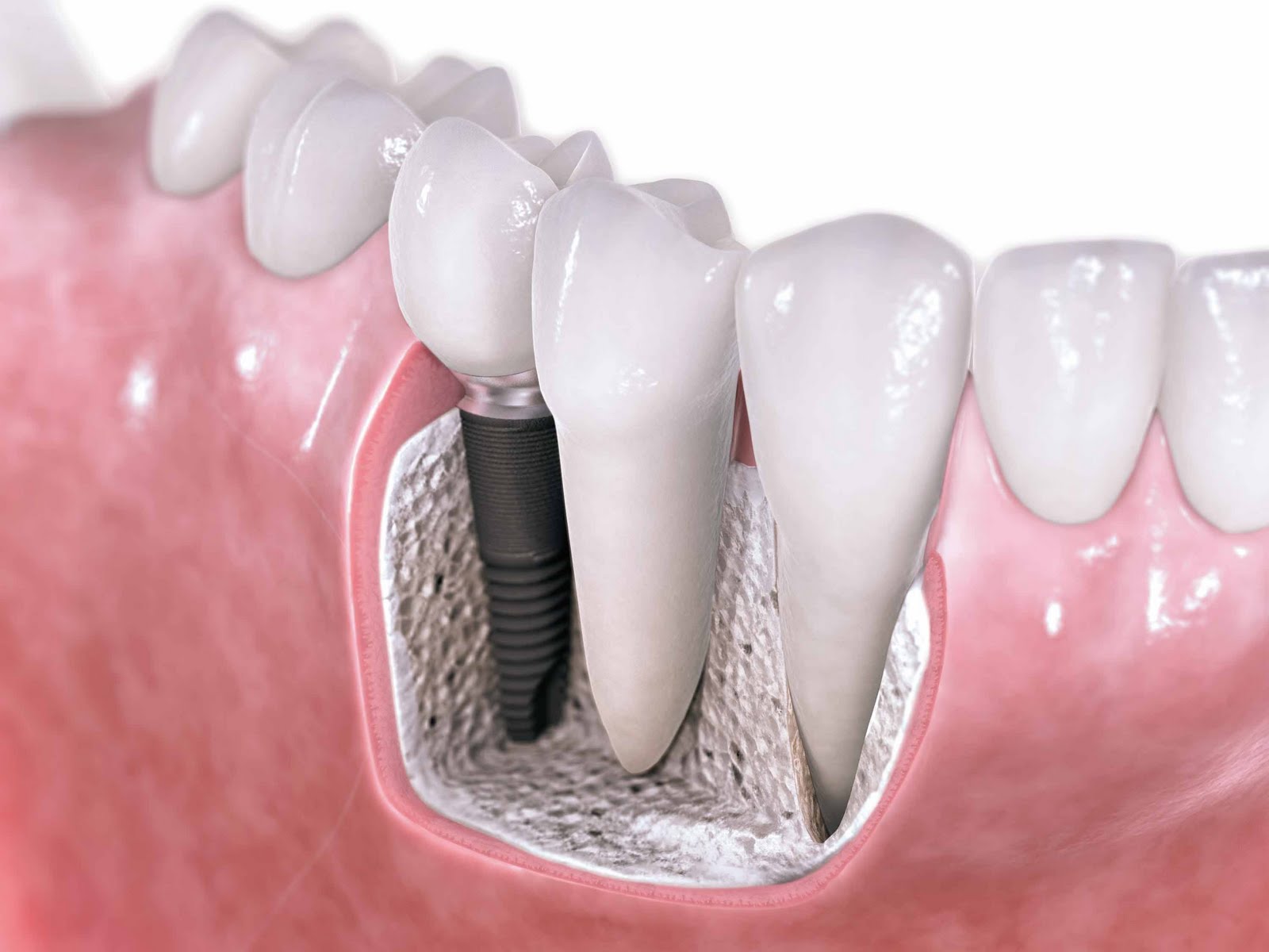 Rigby Advanced Dental: What are Dental Implants?