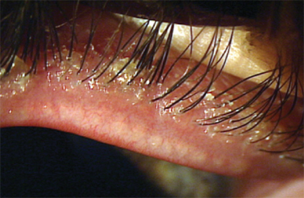 Patient's Guide to Blepharitis - Eyedolatry