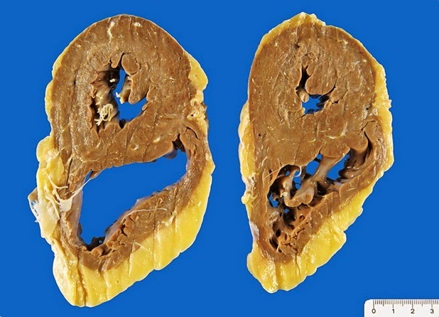 PATOLOGÍA HUMANA: HIPERTROFIA CARDÍACA: UN CAMINO HACIA LA INSUFICIENCIA