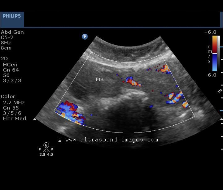 Pedunculated Fibroids Outside The Uterus