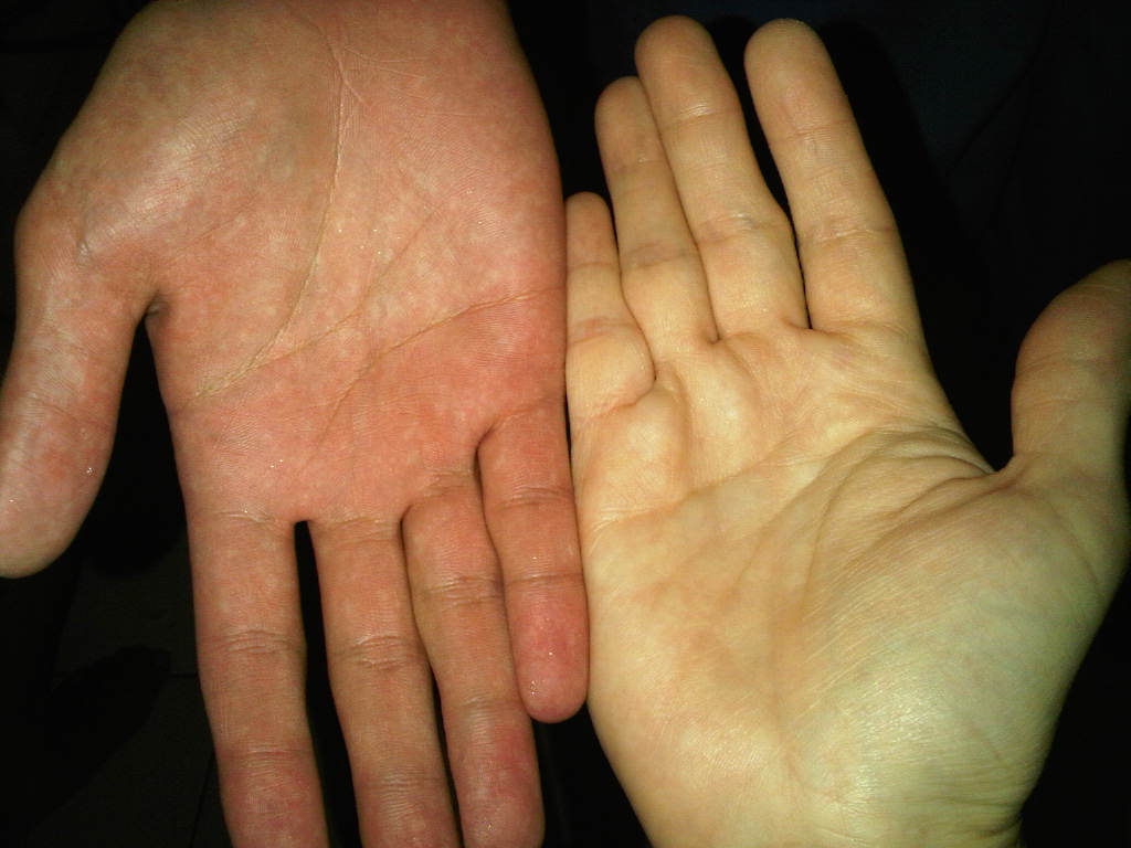 Penyakit Aneh Di Telapak Tangan - Perumperindo.co.id