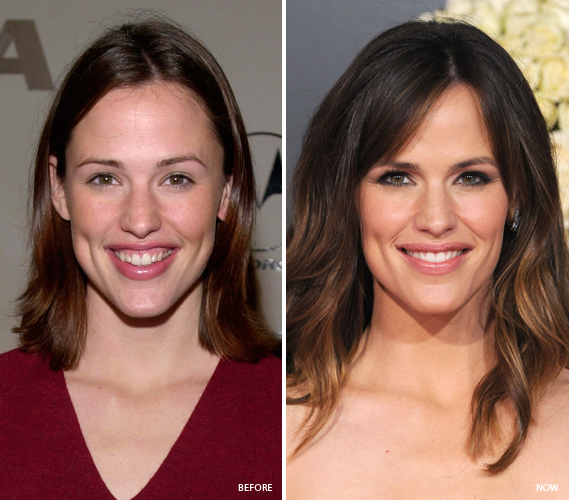 Jennifer Garner Plastic Surgery