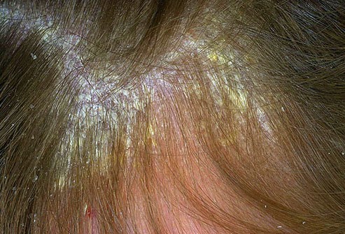 Permanent Psoriasis Relief: What Are The Scalp Psoriasis Signs and ...