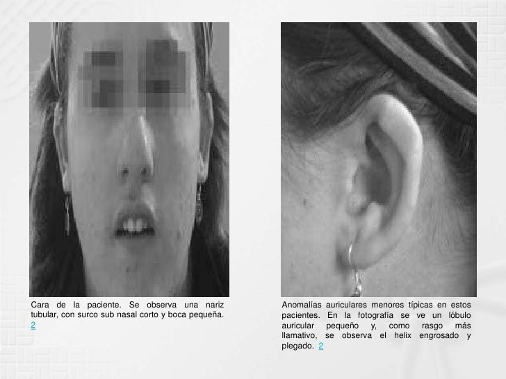 Síndrome de DiGeorge : Anatomia del Sindrome Digeorge