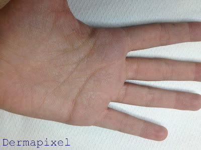 Dermapixel: junio 2013