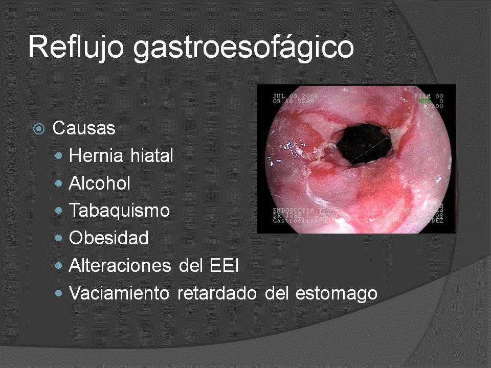 PATOLOGIA B: Esófago de Barret
