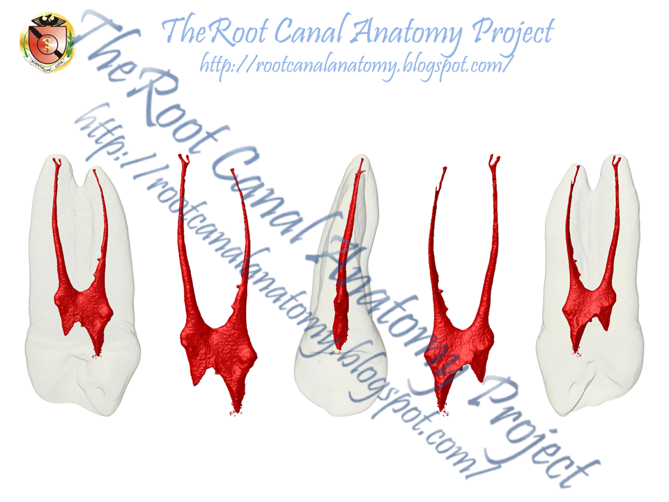 The Root Canal Anatomy Project: Maxillary First Premolar