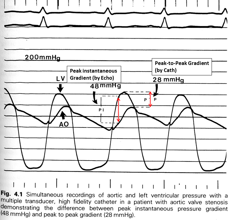 Pedi cardiology: Gradient measurement difference between echo vs. cath ...