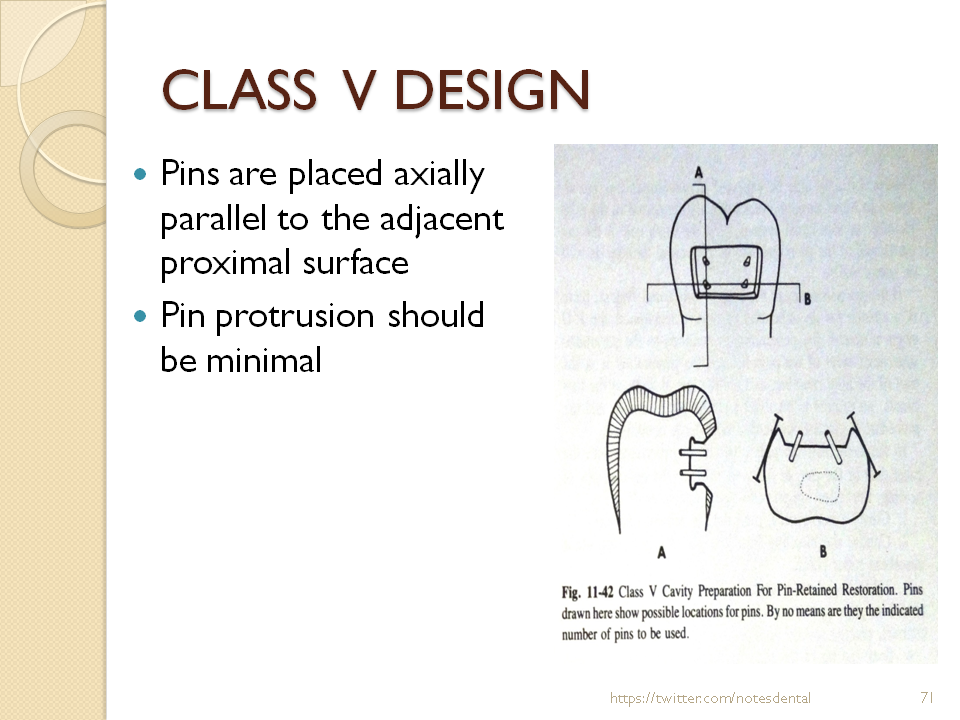 Dental Notes: Pin Retained Restorations NOTES