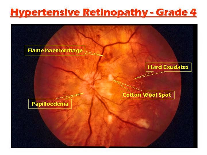 Emergency Medicine: Diabetic & Hypertensive Retinopathy