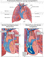 Pulmonary Edema Causes, Symptoms and Treatment