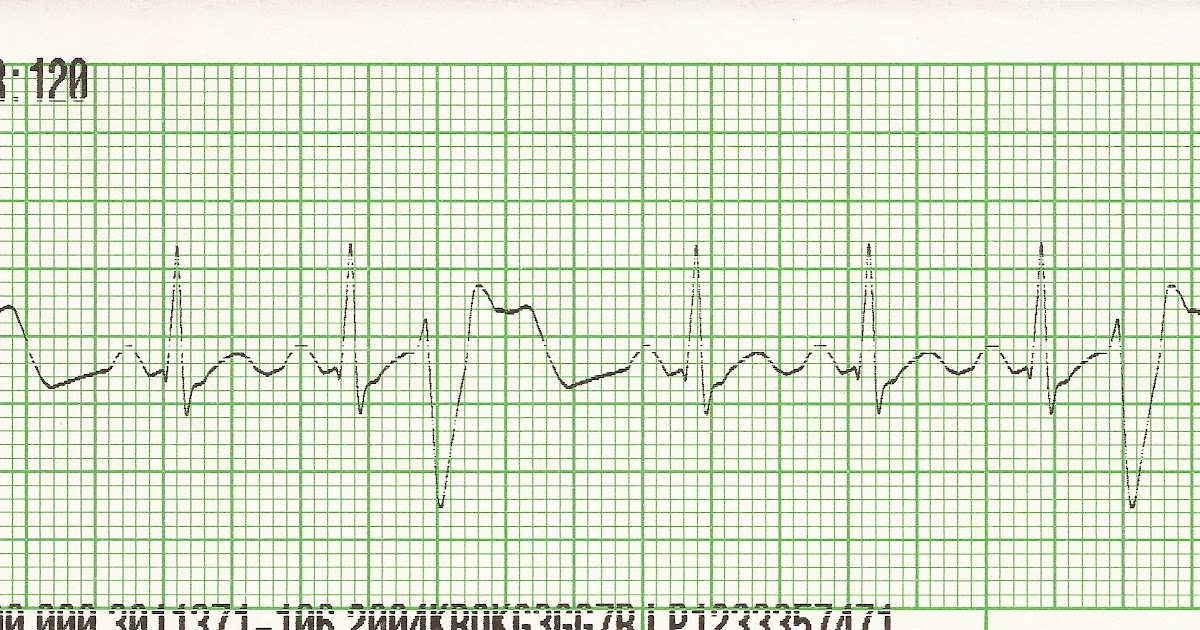 EKG Rhythm Strips 11- ectopic beats